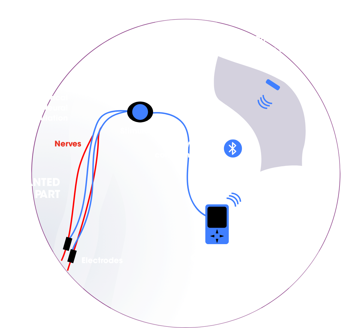 Neurinnov - Innovation in Neurostimulation - Neurinnov